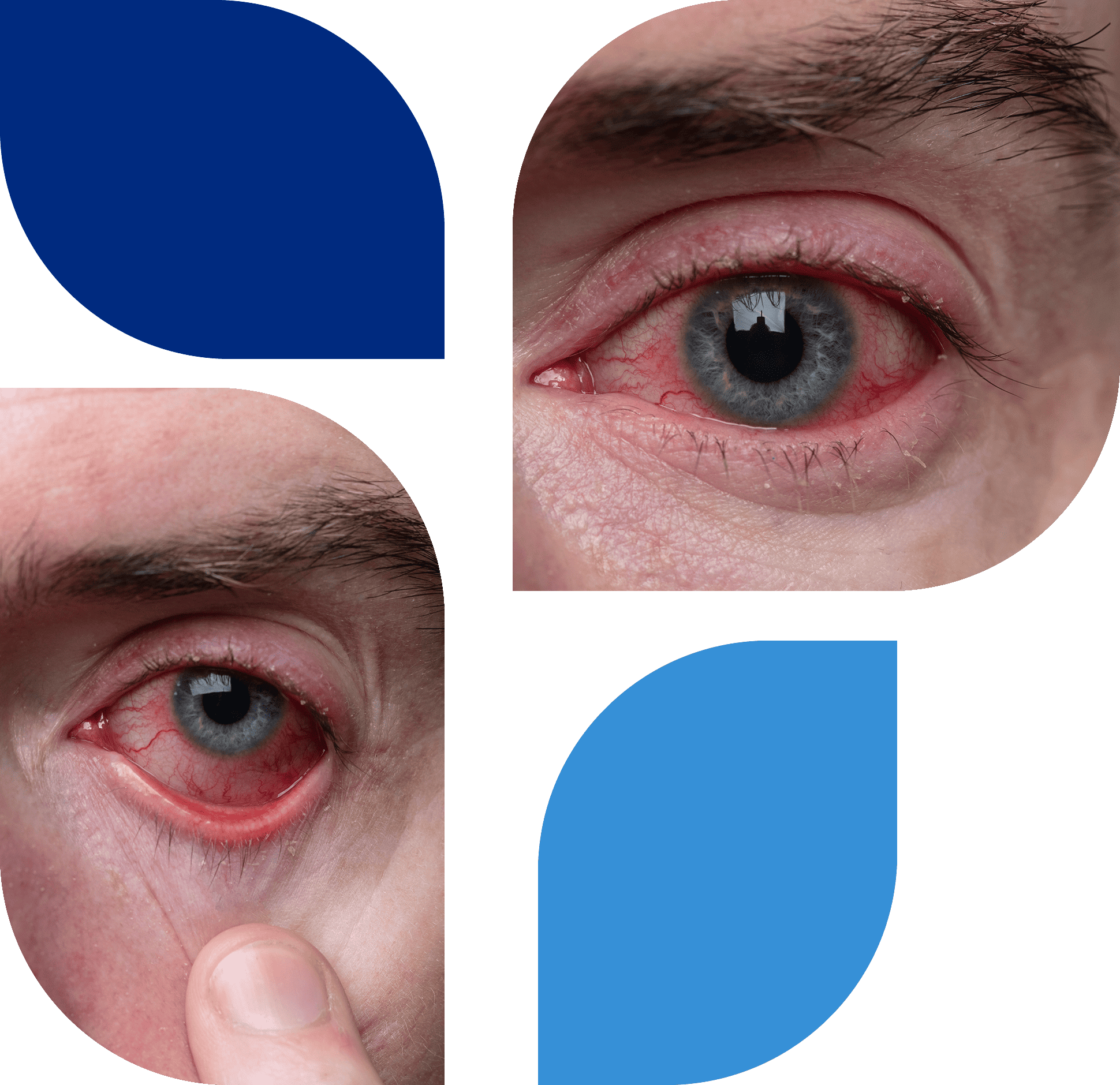 Pink Eye and Red Eye Treatment | Expert Eye Care